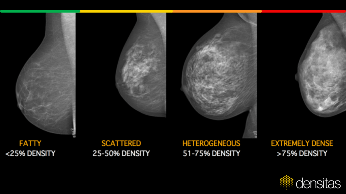 Breast density is an independent risk factor for breast cancer and ...